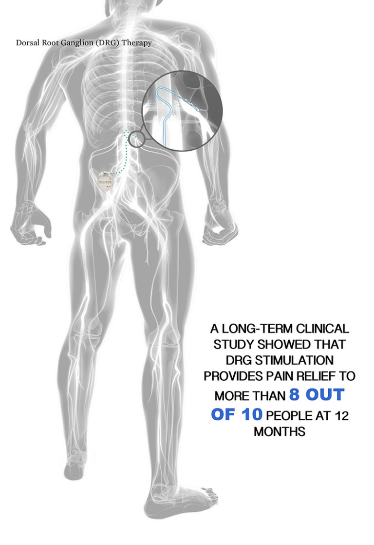 Dorsal Root Ganglion Stimulation - Dr. Justin Lo, MD